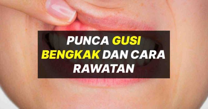 Punca Gusi Bengkak Dan Bernanah Dan Cara Merawat